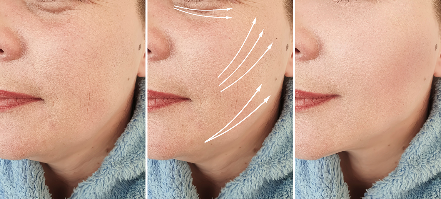 Fadenlifting - Ästhetische Medizin Dr. med. Jürgen Kaiser